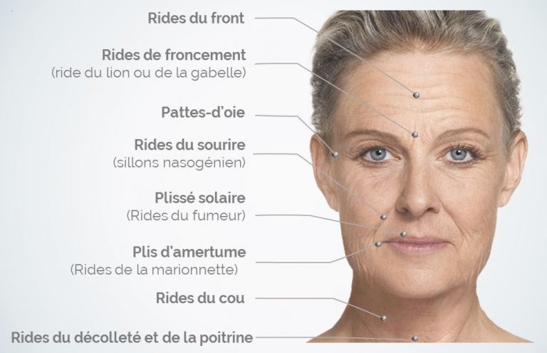 Traitement des rides du visage : filler, peeling, lifting cervico facial